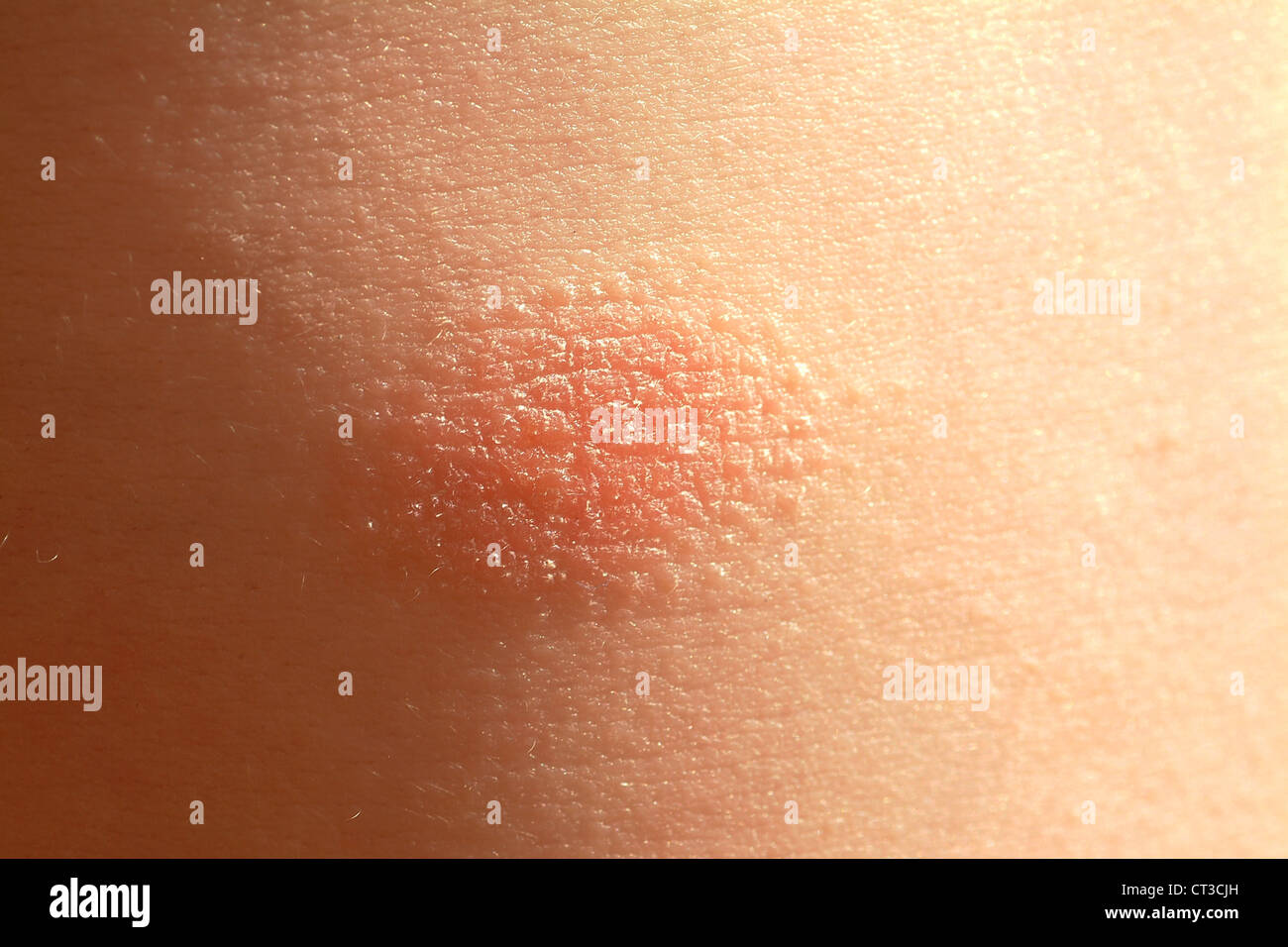 Desquamation of the skin hi-res stock photography and images - Alamy