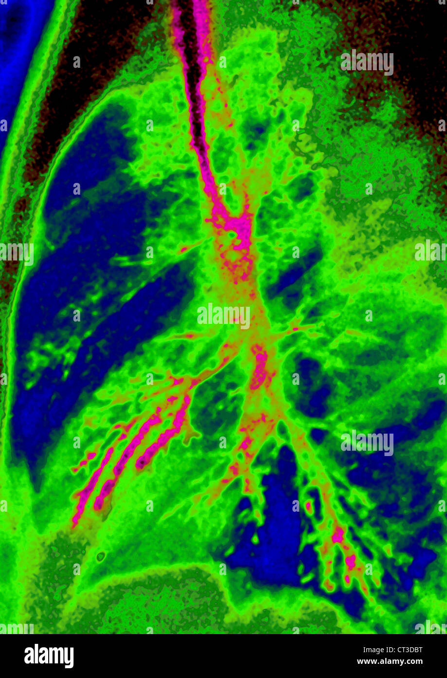 Bronchiectasis X Ray High Resolution Stock Photography and Images - Alamy
