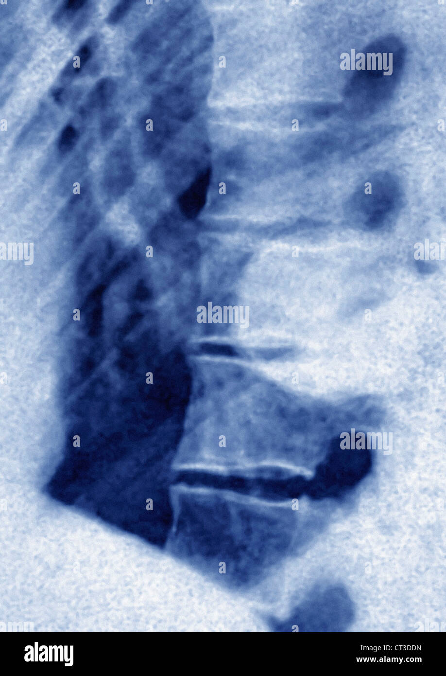 MENINGOCELE X-RAY RESULT Stock Photo - Alamy