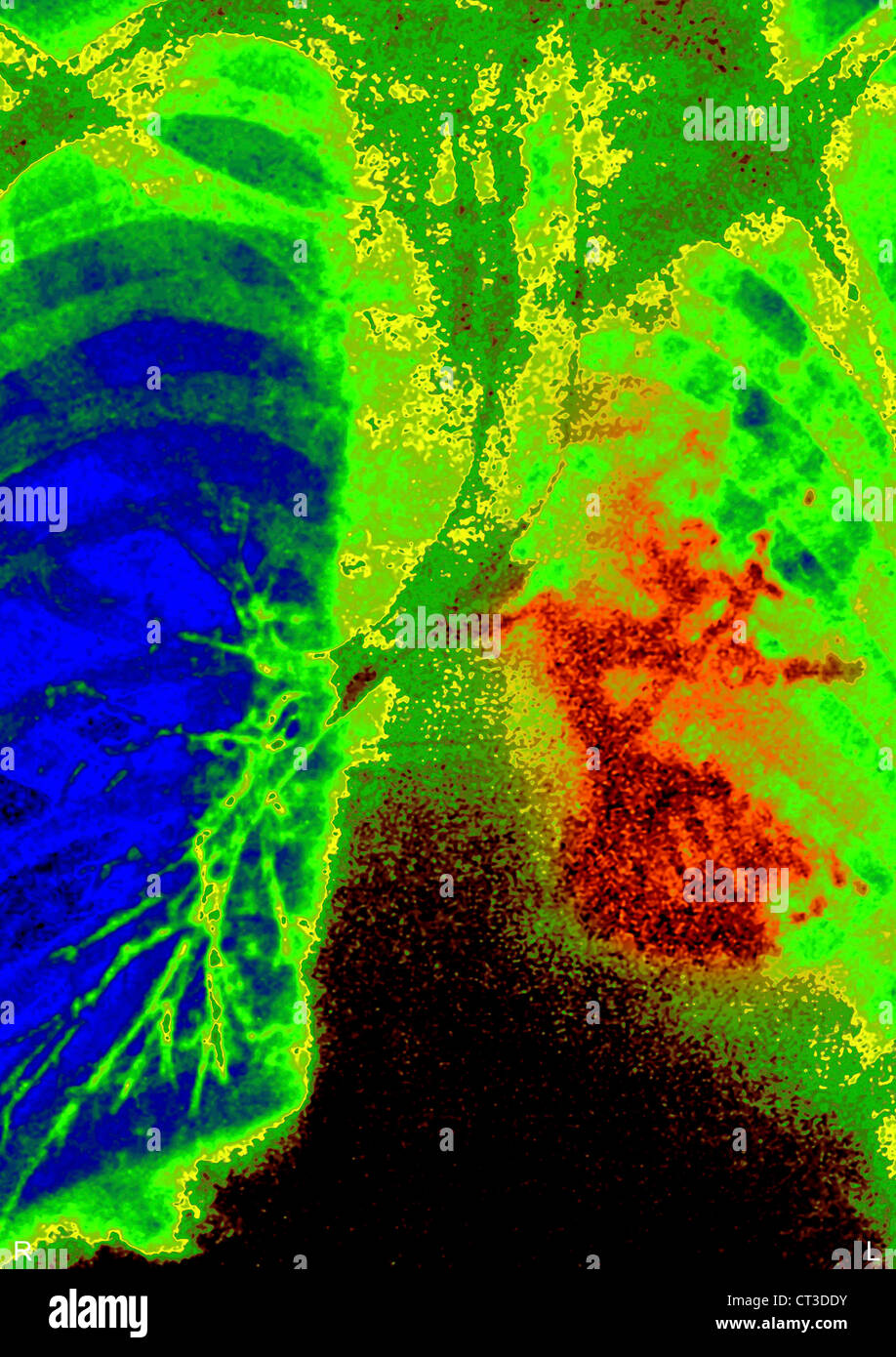 BRONCHIAL RUPTURE, X-RAY Stock Photo - Alamy