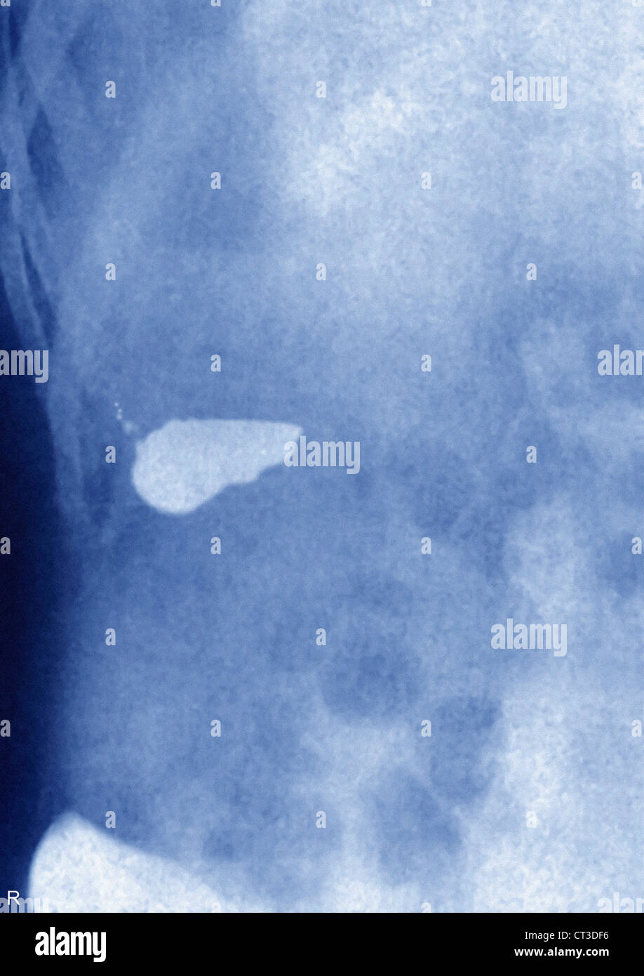 Subphrenic abscess hi-res stock photography and images - Alamy