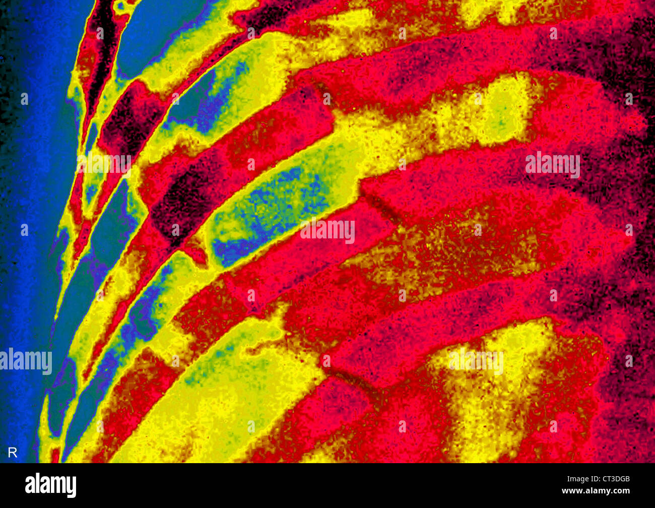 Fractured ribs x ray hi-res stock photography and images - Alamy