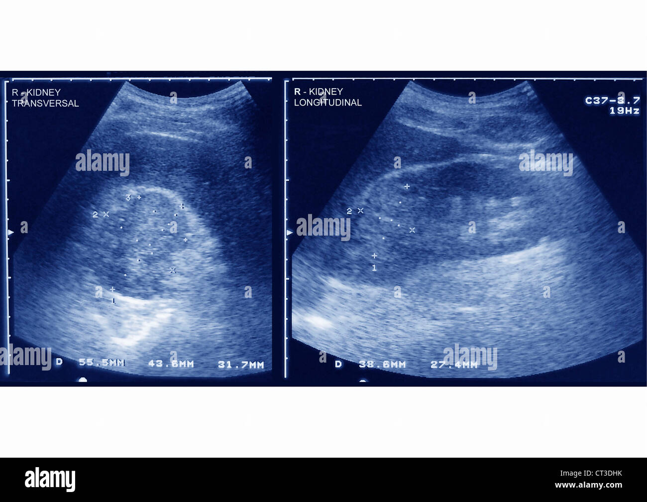 Kidney Anatomy Ultrasound