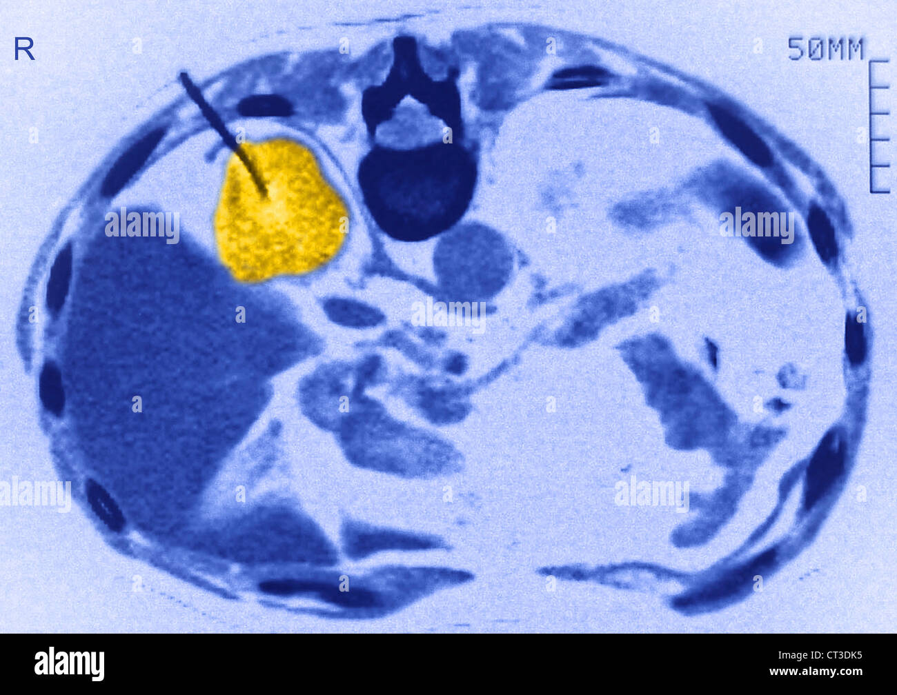 RENAL BIOPSY, SCAN Stock Photo - Alamy