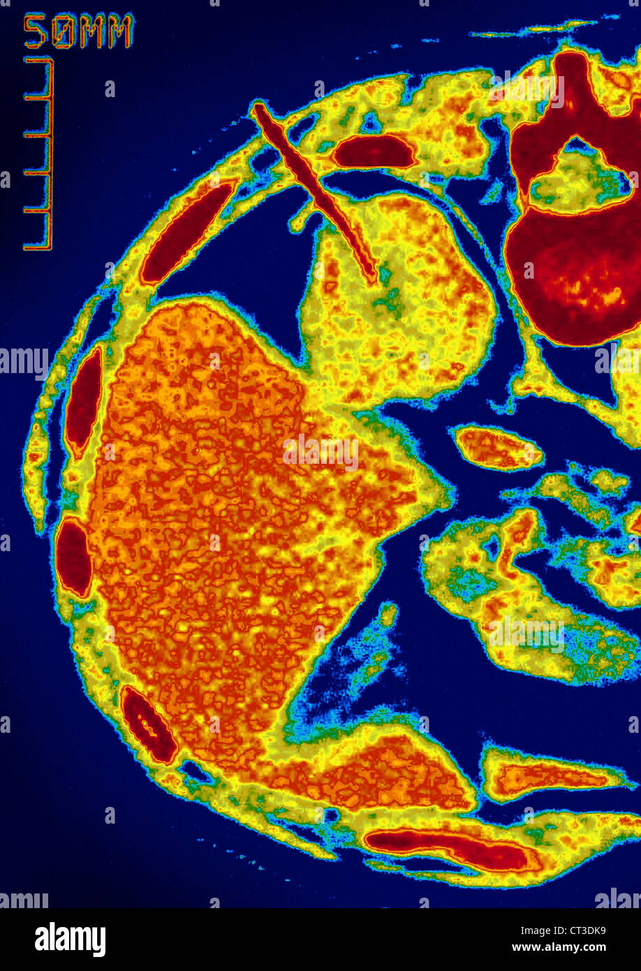 RENAL BIOPSY, SCAN Stock Photo - Alamy