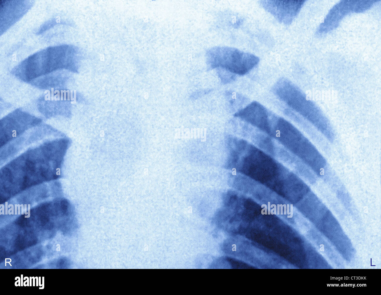 ESOPHAGEAL ABSCESS, X-RAY Stock Photo - Alamy