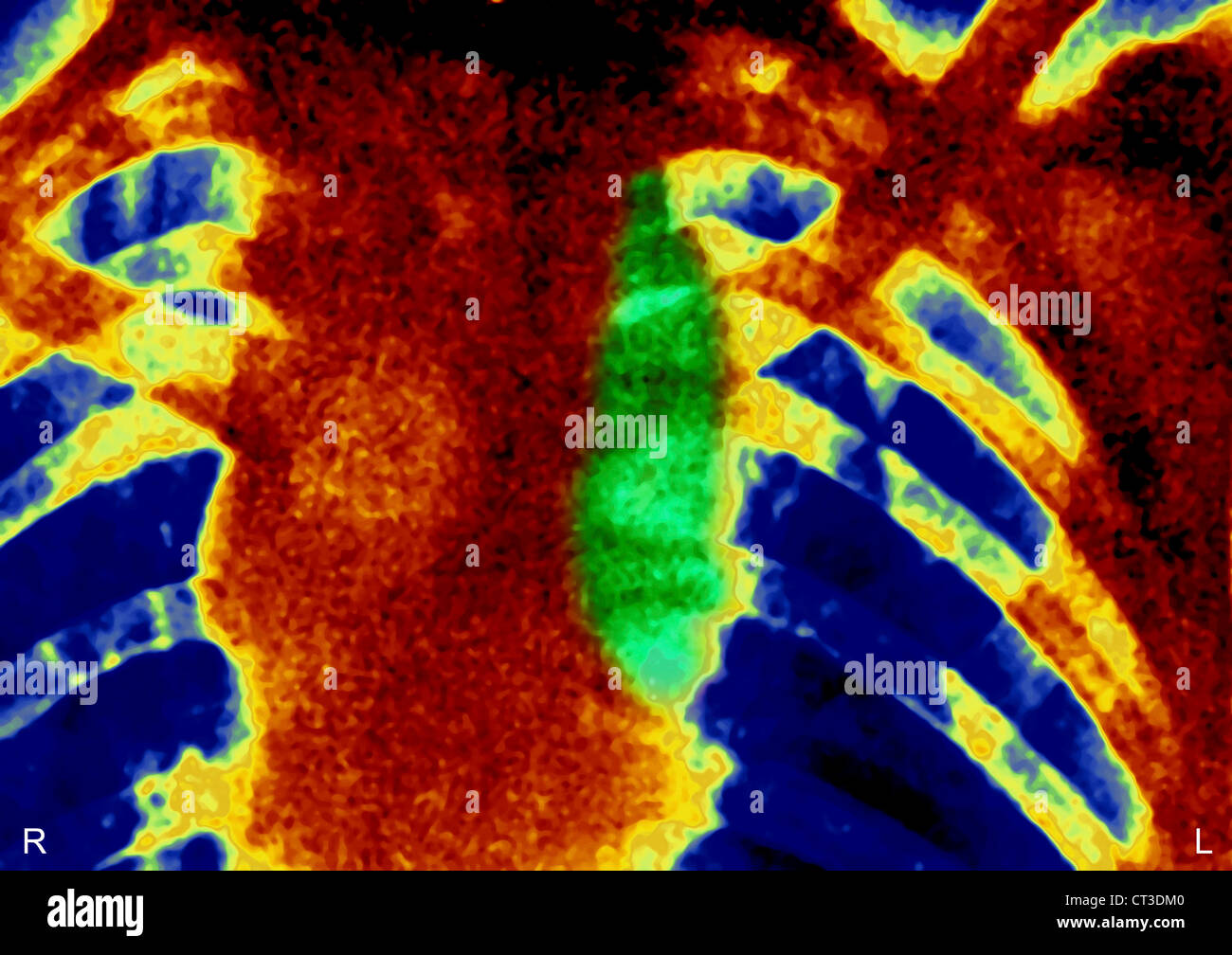 ESOPHAGEAL ABSCESS, X-RAY Stock Photo - Alamy