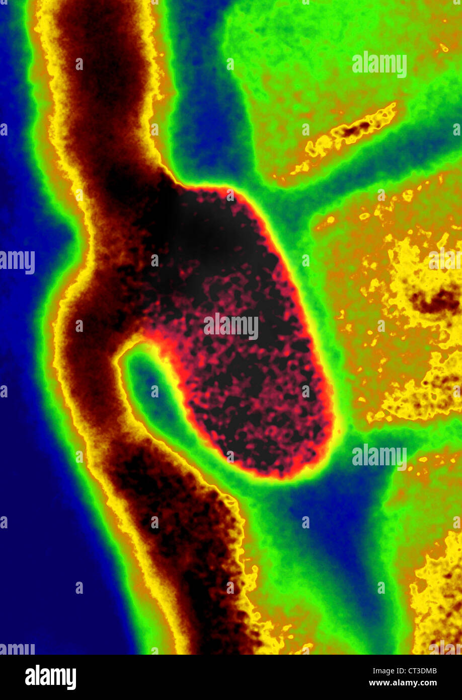 Esophageal diverticulum hi-res stock photography and images - Alamy