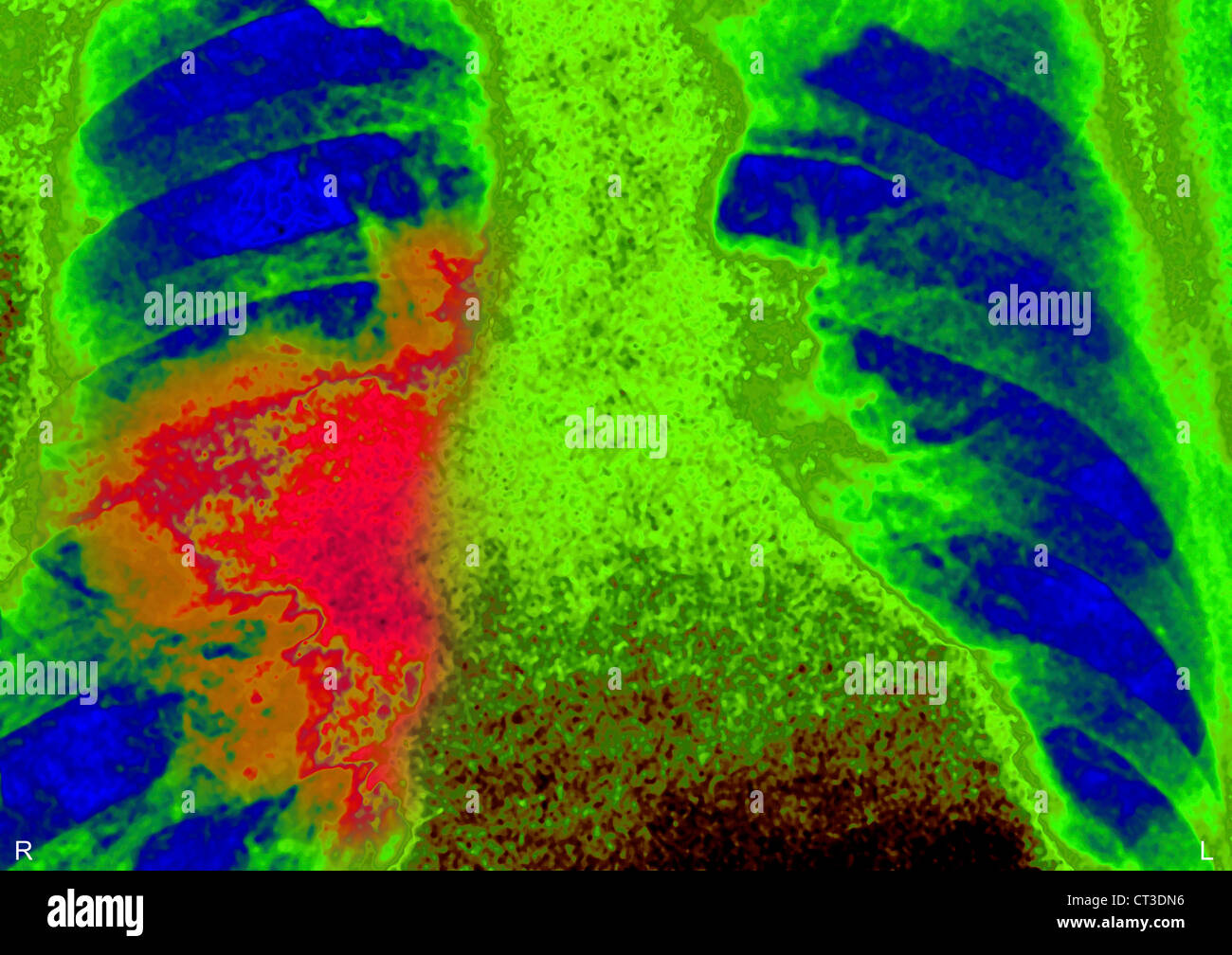 LUNG CANCER, X-RAY Stock Photo - Alamy