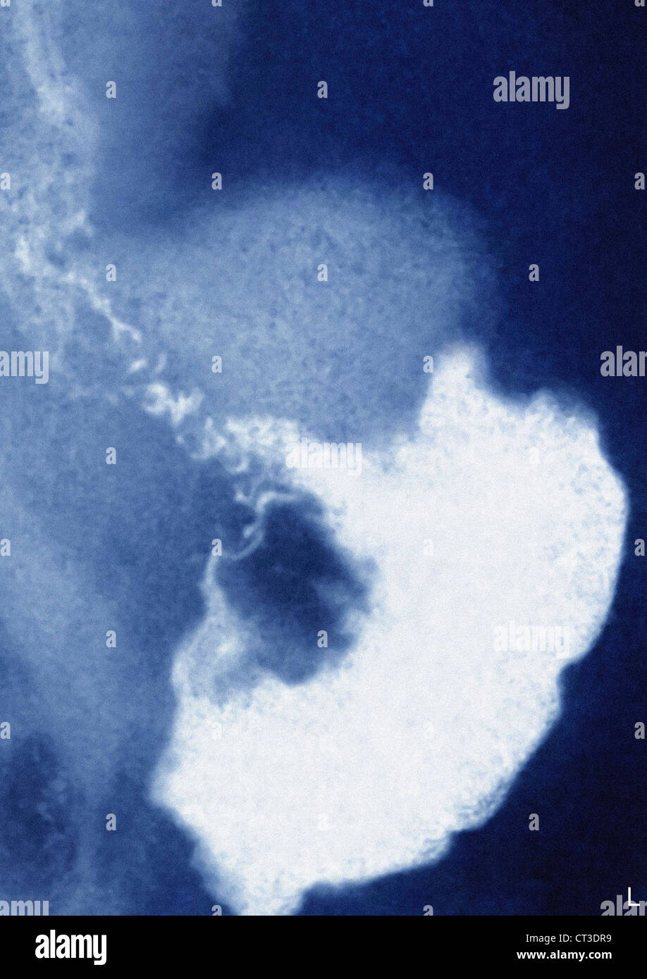 GASTRIC CARCINOMA, X-RAY Stock Photo - Alamy
