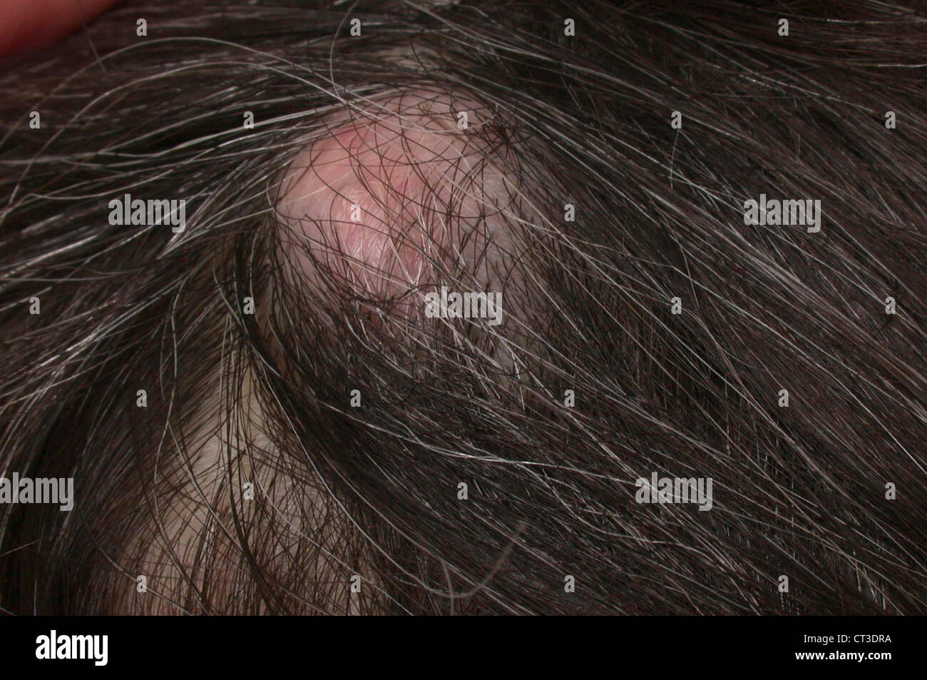 Sebaceous Cyst Stock Photos & Sebaceous Cyst Stock Images - Alamy