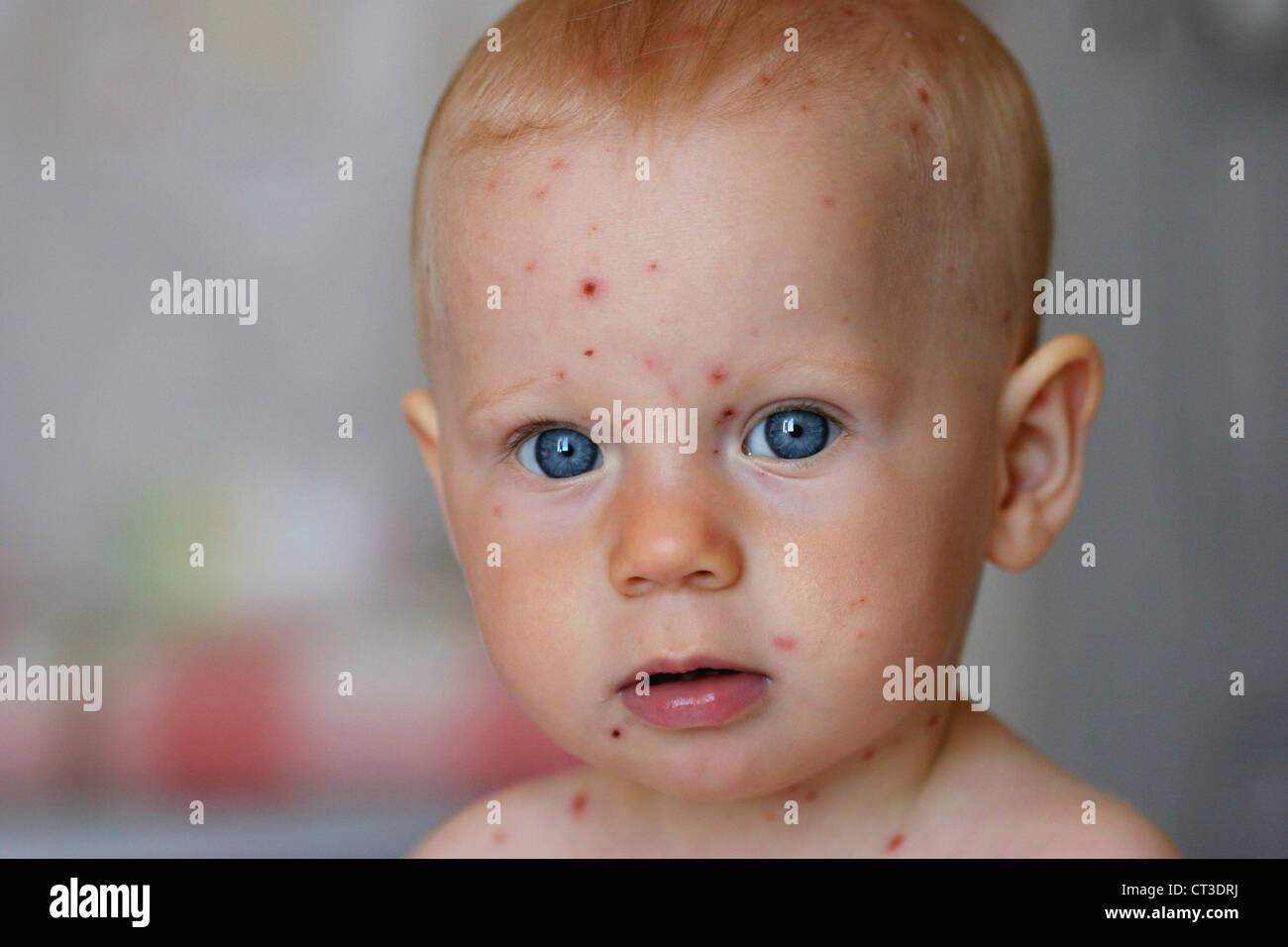 Year old child chickenpox hi-res stock photography and images - Alamy