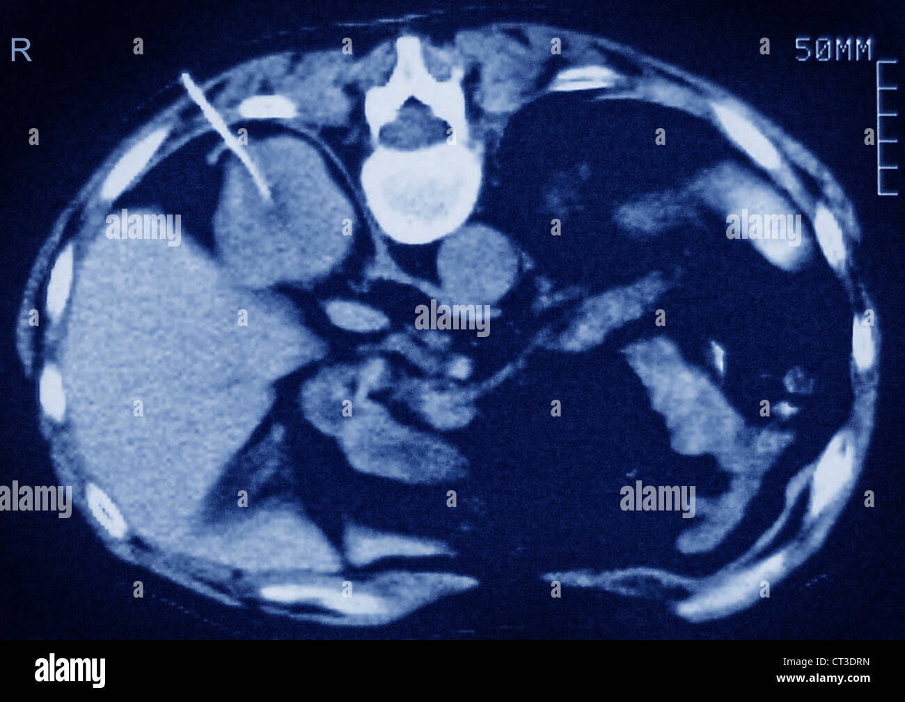 RENAL BIOPSY, SCAN Stock Photo - Alamy