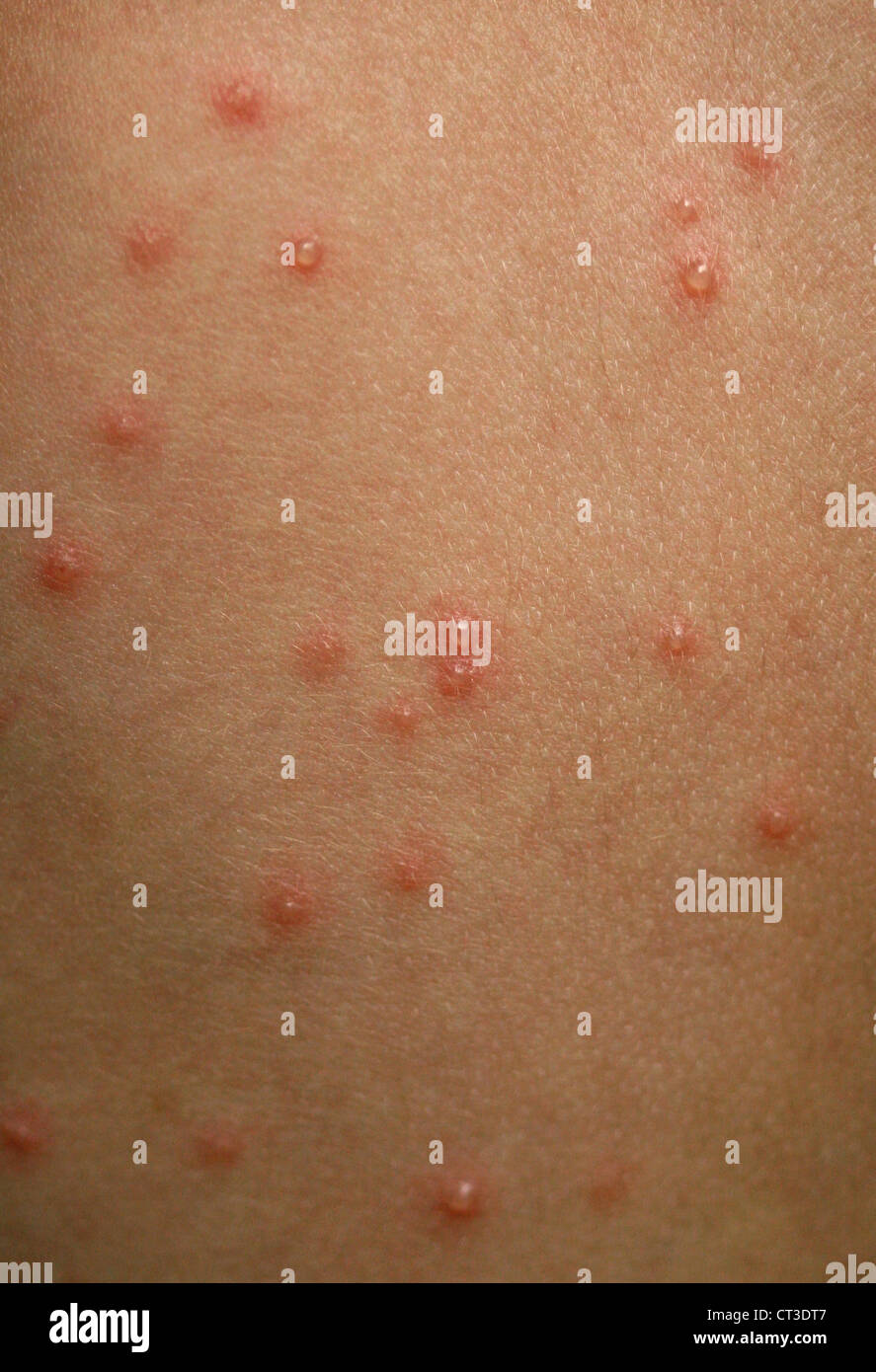 CHICKENPOX Stock Photo - Alamy