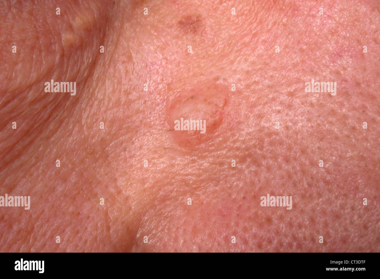 Nevus nose hi-res stock photography and images - Alamy