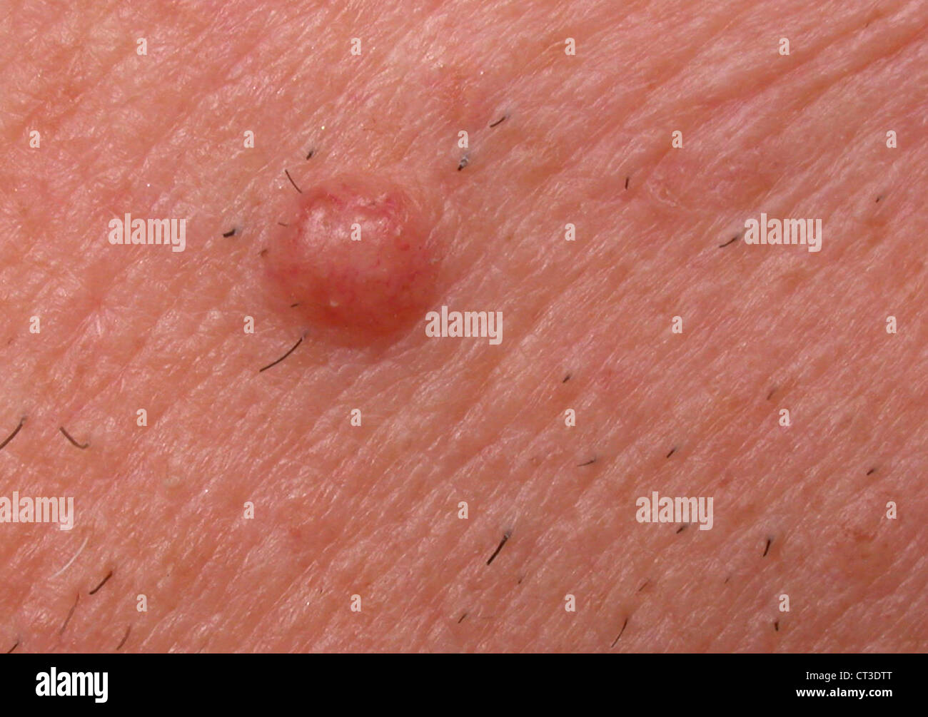 Nevocellular hi-res stock photography and images - Alamy