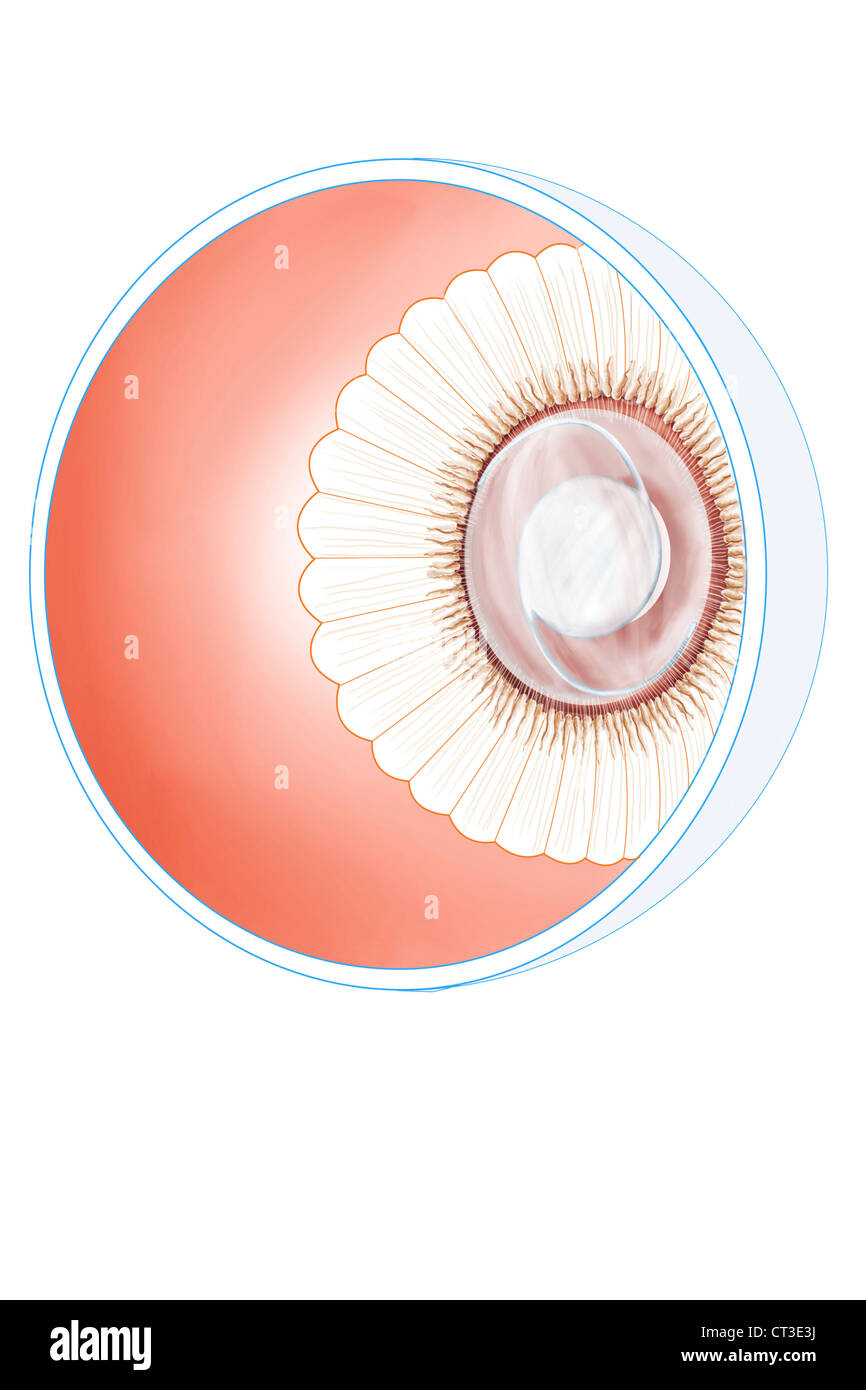 Implanted lenses hi-res stock photography and images - Alamy