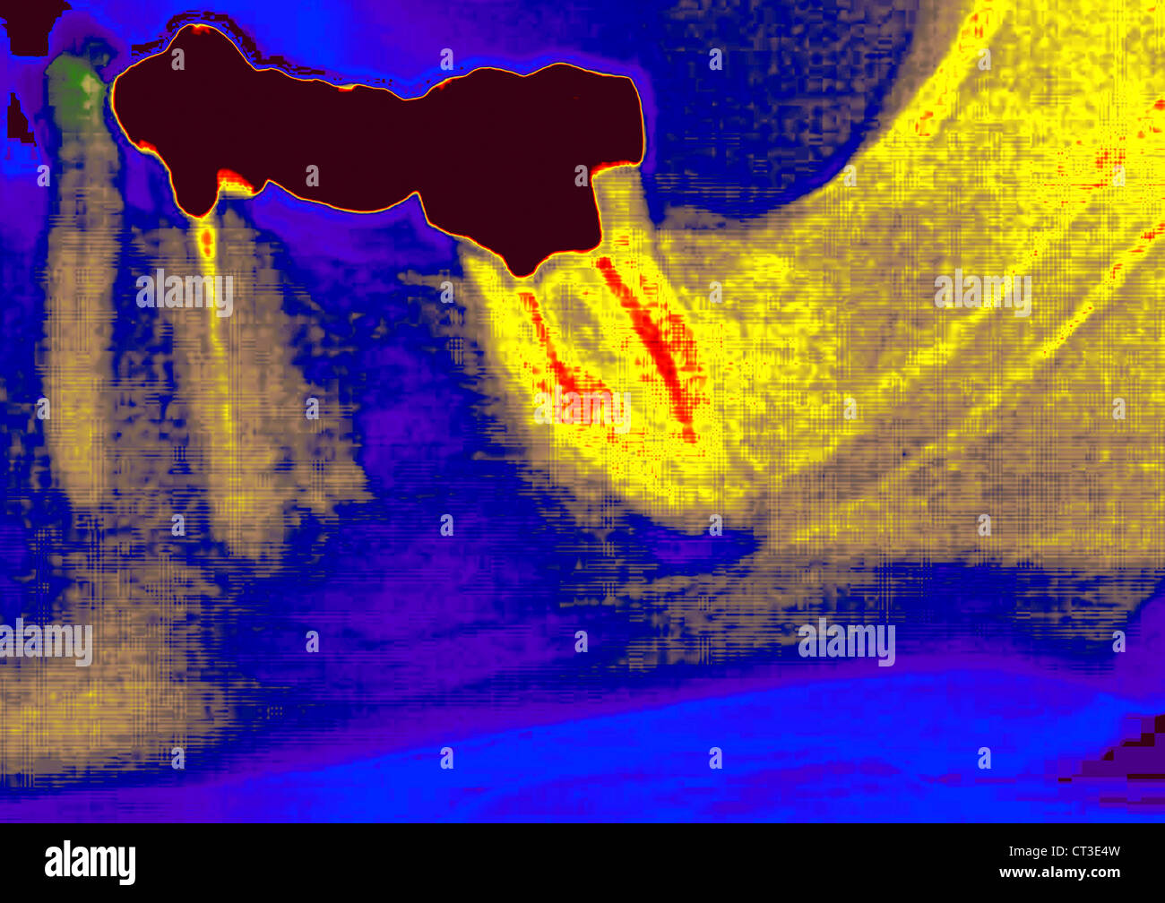 Osteitis x ray hi-res stock photography and images - Alamy