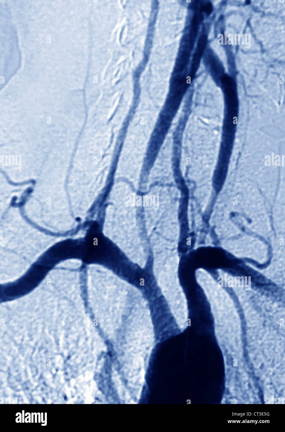 VENOUS STENOSIS, ANGIOGRAPHY Stock Photo - Alamy