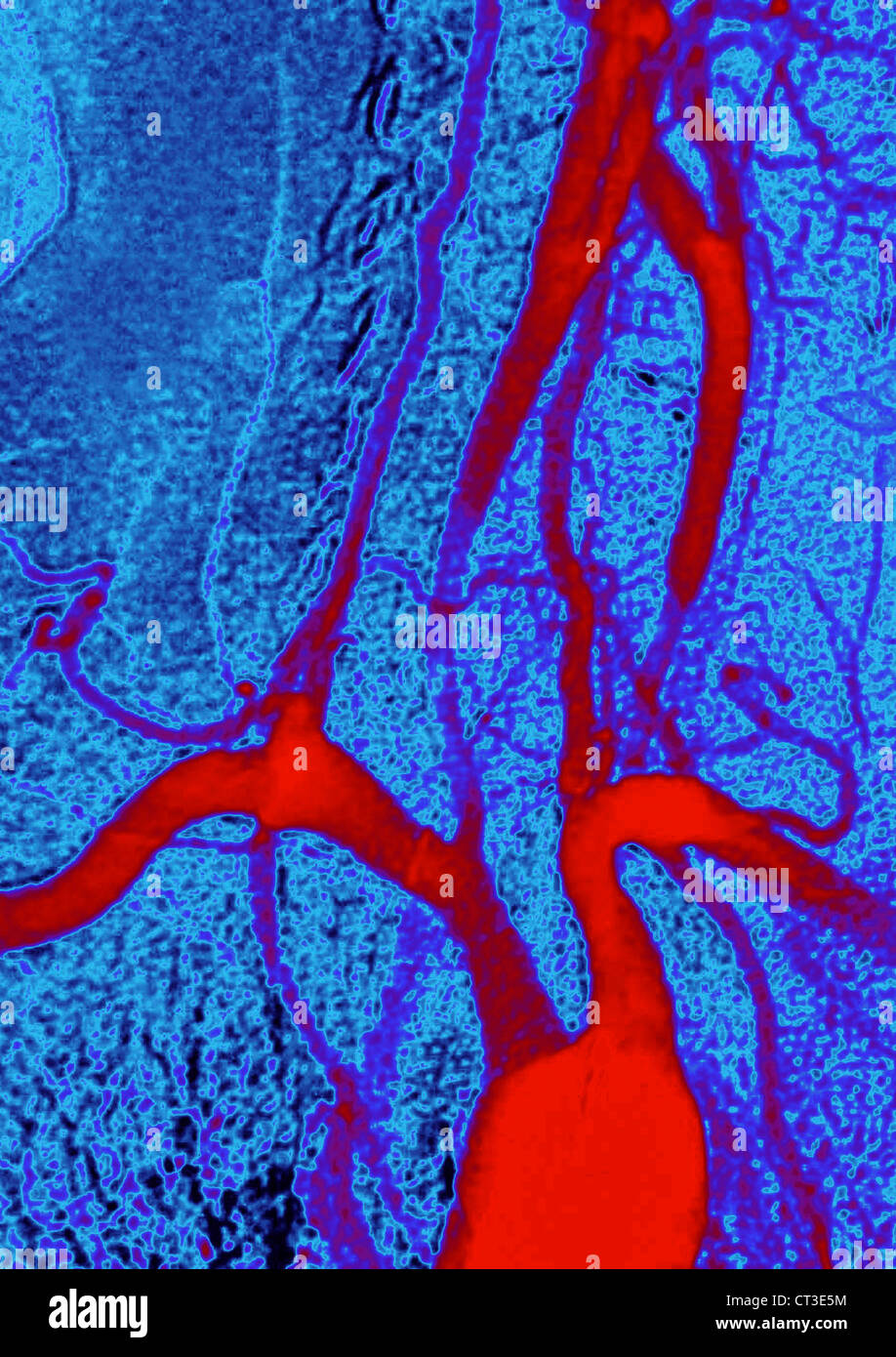 VENOUS STENOSIS, ANGIOGRAPHY Stock Photo - Alamy