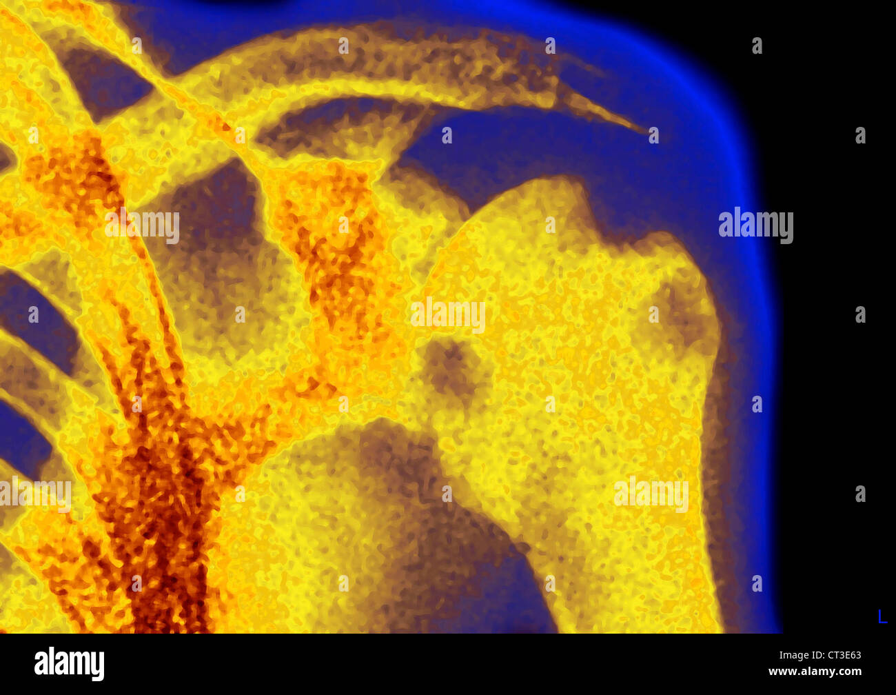 TUBERCULOSIS IN THE BONES, X-RAY Stock Photo - Alamy