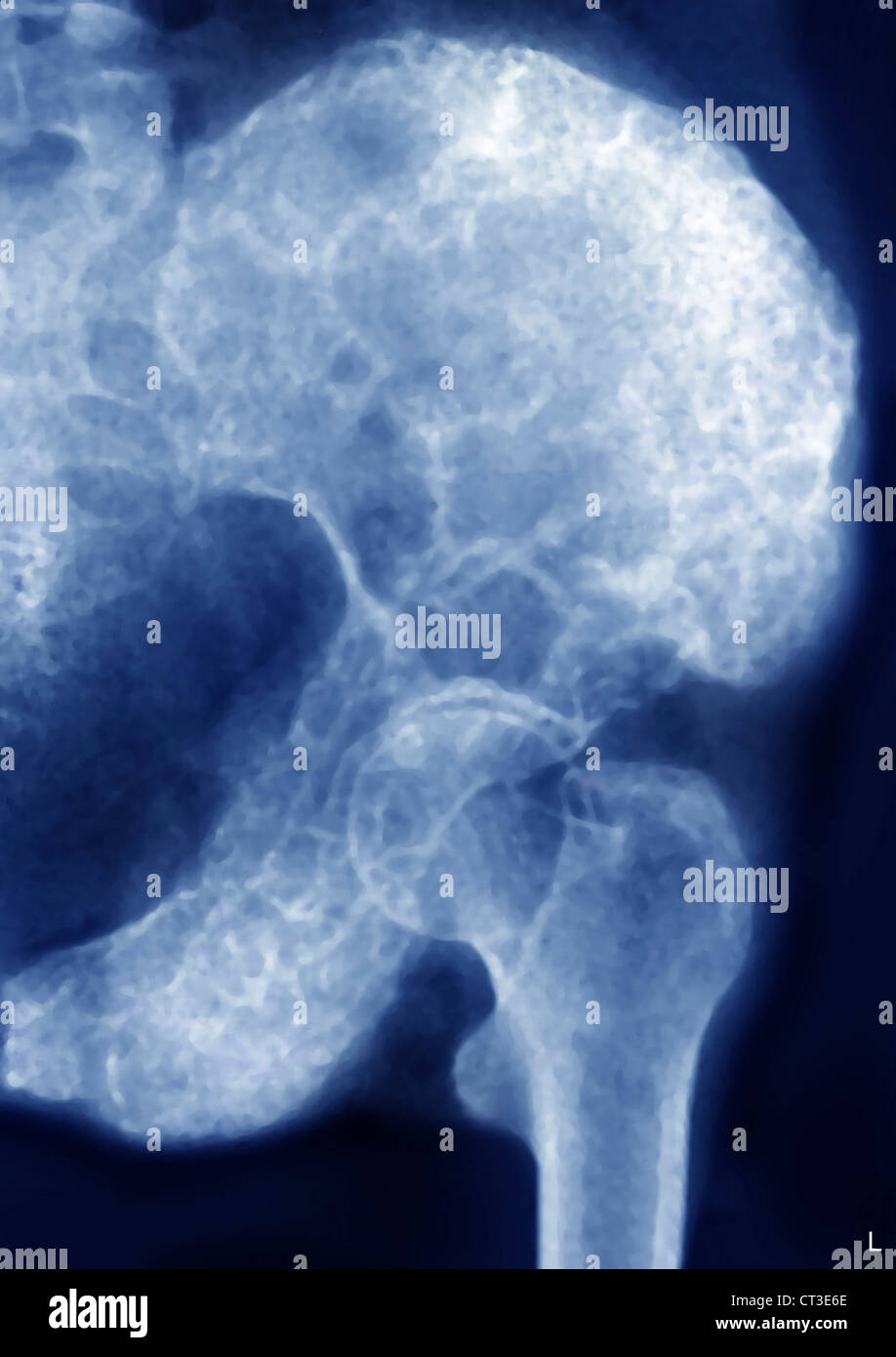 Iliac wing hi-res stock photography and images - Alamy