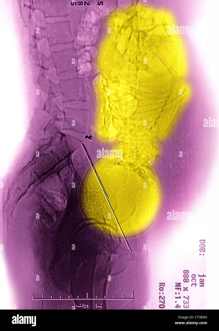 Pelvic Exam High Resolution Stock Photography and Images - Alamy