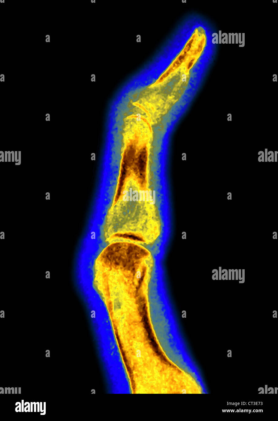 ARTHRITIS HAND, X-RAY Stock Photo - Alamy