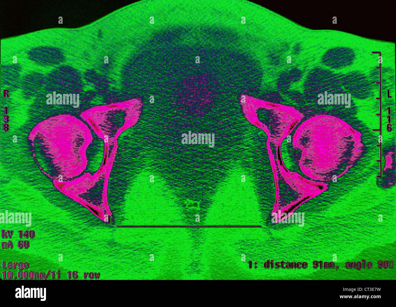 Pelvimetry hi-res stock photography and images - Alamy