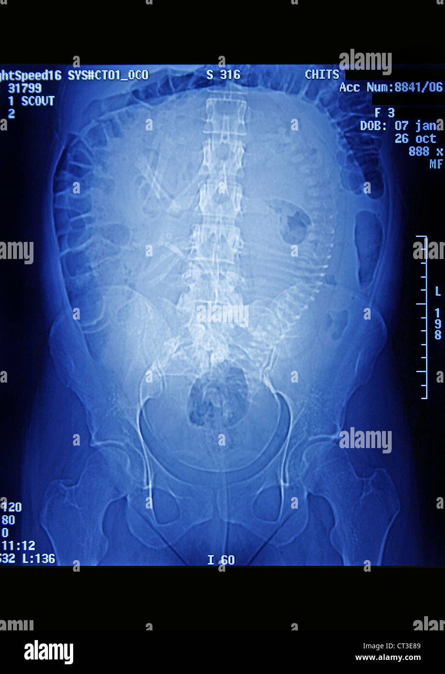 PELVIMETRY Stock Photo - Alamy