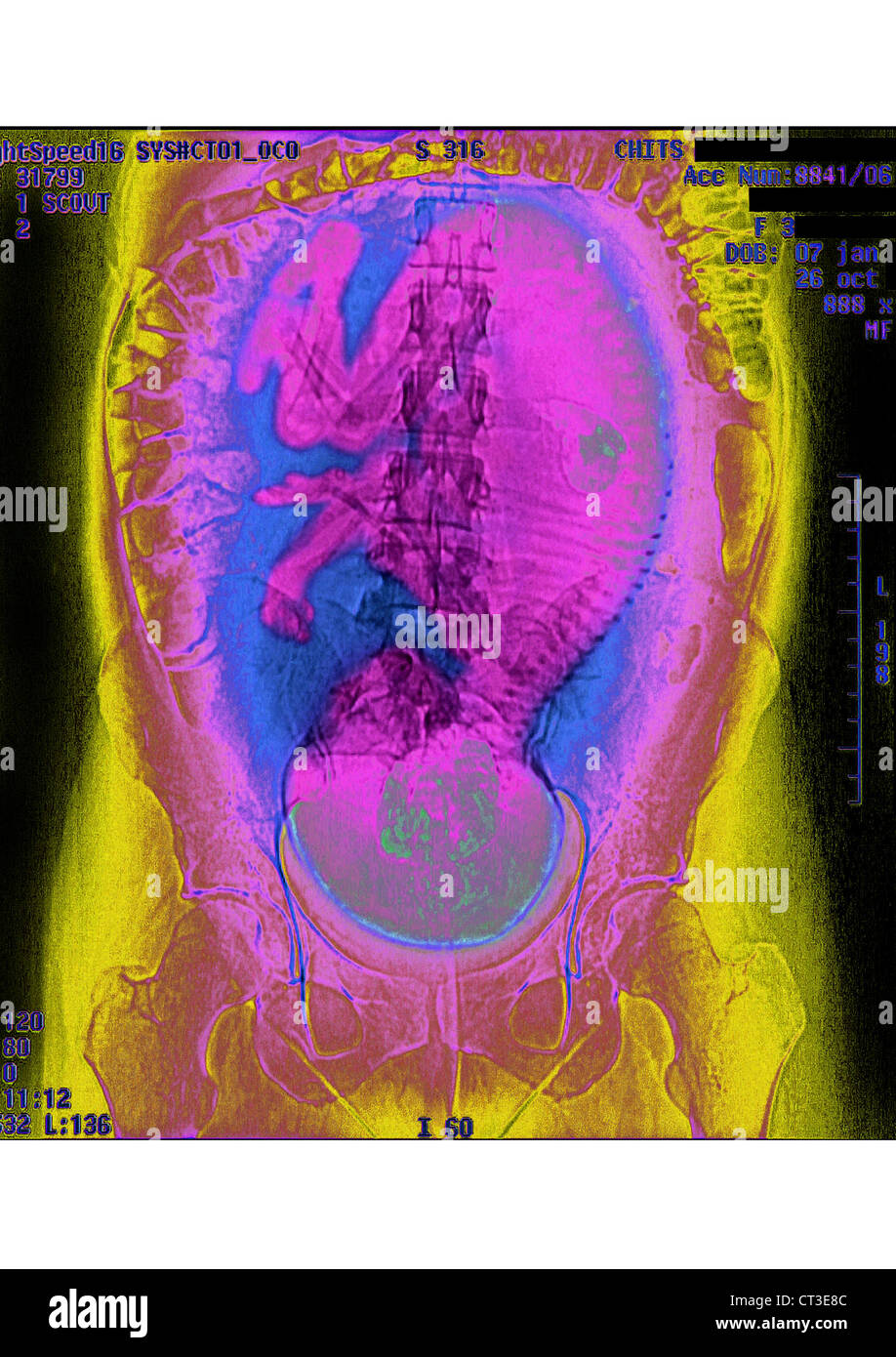 PELVIMETRY Stock Photo Alamy pelvimetry-stock-photo-alamy