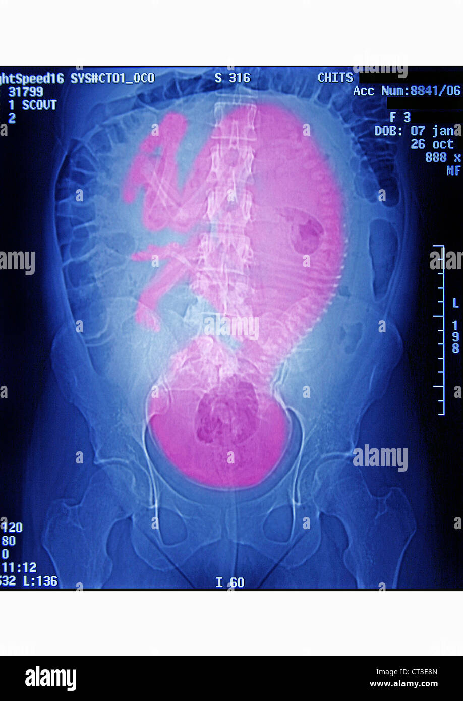 Pelvic Exam Stock Photos & Pelvic Exam Stock Images - Alamy