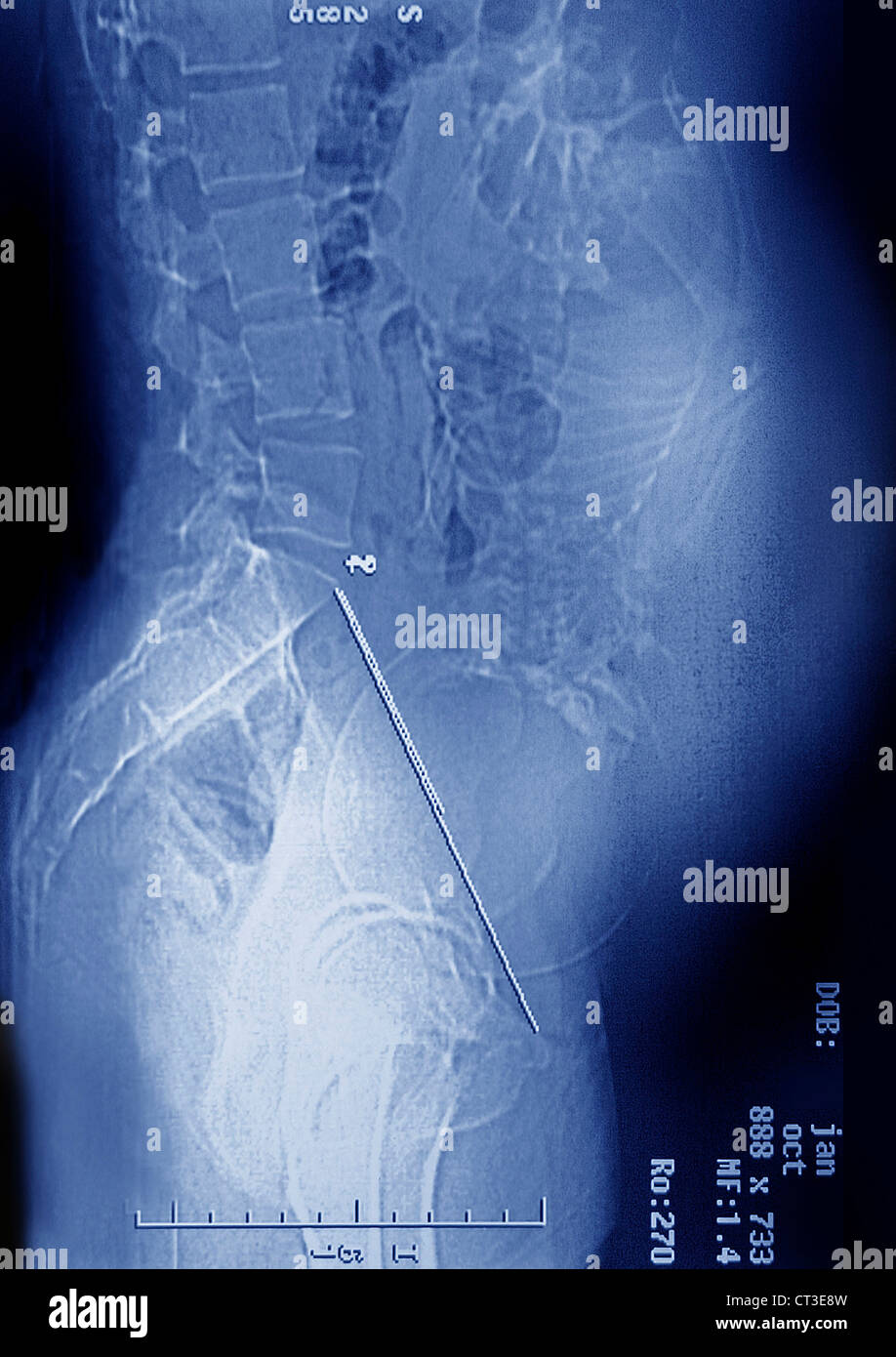 PELVIMETRY Stock Photo - Alamy