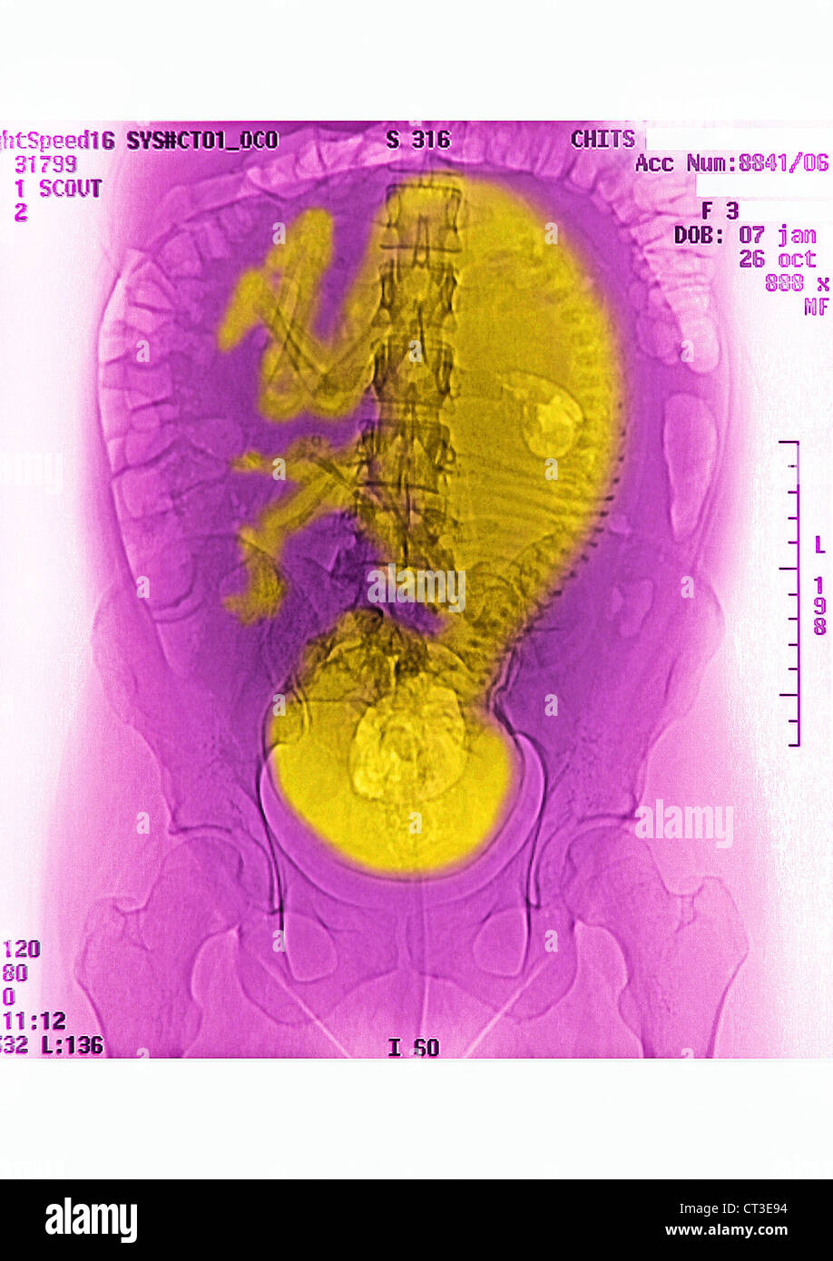 Pelvimetry hi-res stock photography and images - Alamy