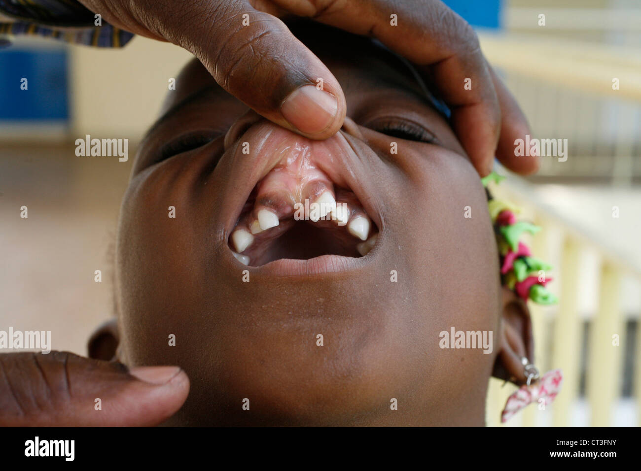 Malpositioned tooth hi-res stock photography and images - Alamy