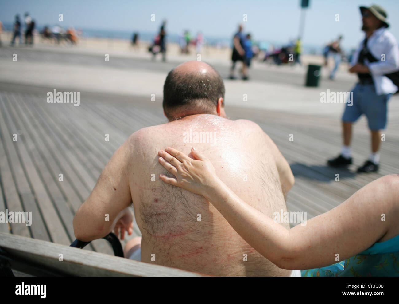Man sunburnt tan hi-res stock photography and images - Alamy