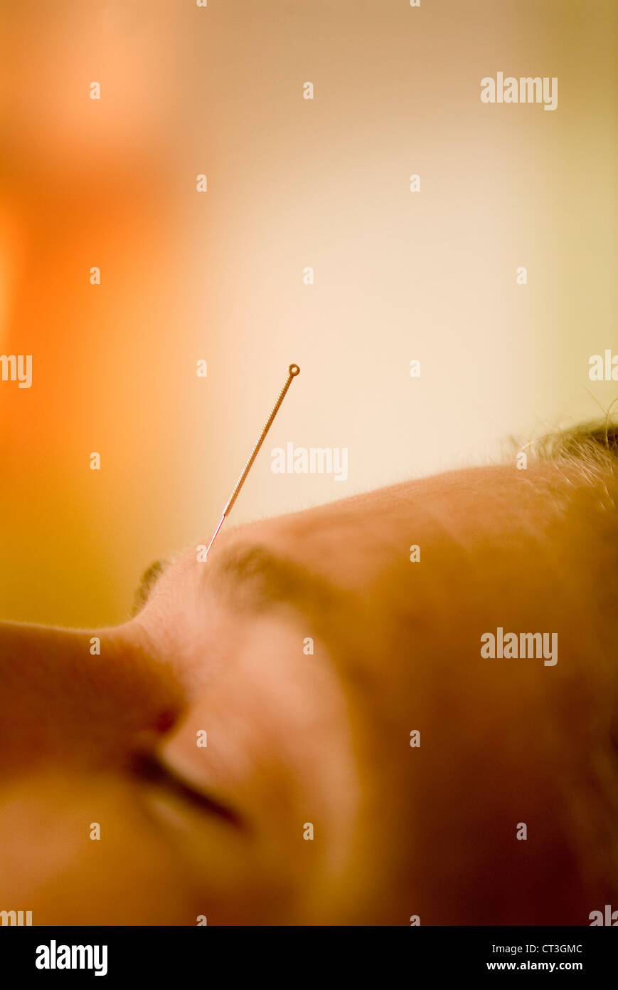 Acupuncture man face hi-res stock photography and images - Alamy