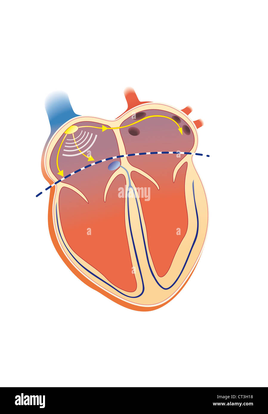 ATRIOVENTRICULAR BLOCK Stock Photo - Alamy ATRIOVENTRICULAR BLOCK Stock Photo - Alamy