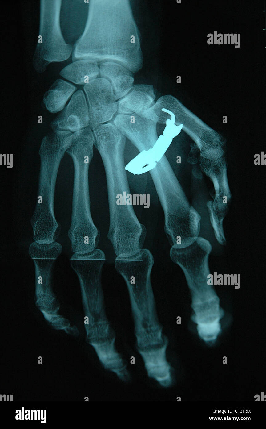 X Rays Of Objects Inside People