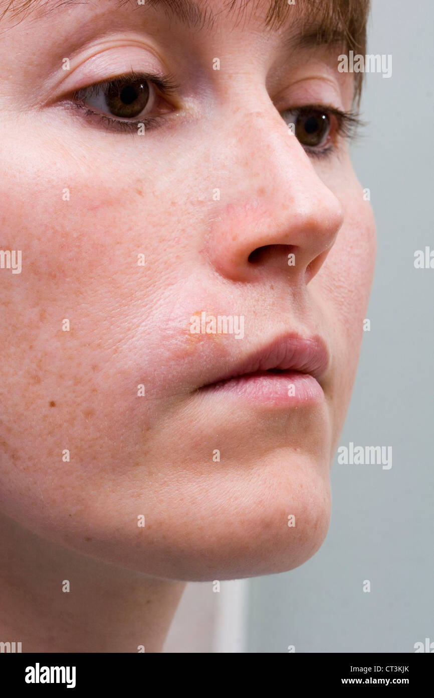 Herpes vesicle hi-res stock photography and images - Alamy