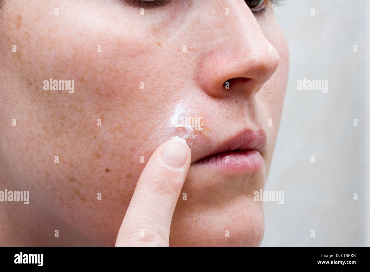 Herpes vesicle hi-res stock photography and images - Alamy