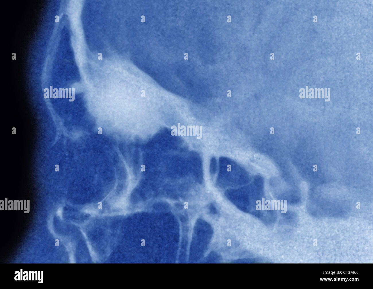 Osteoma hi-res stock photography and images - Alamy