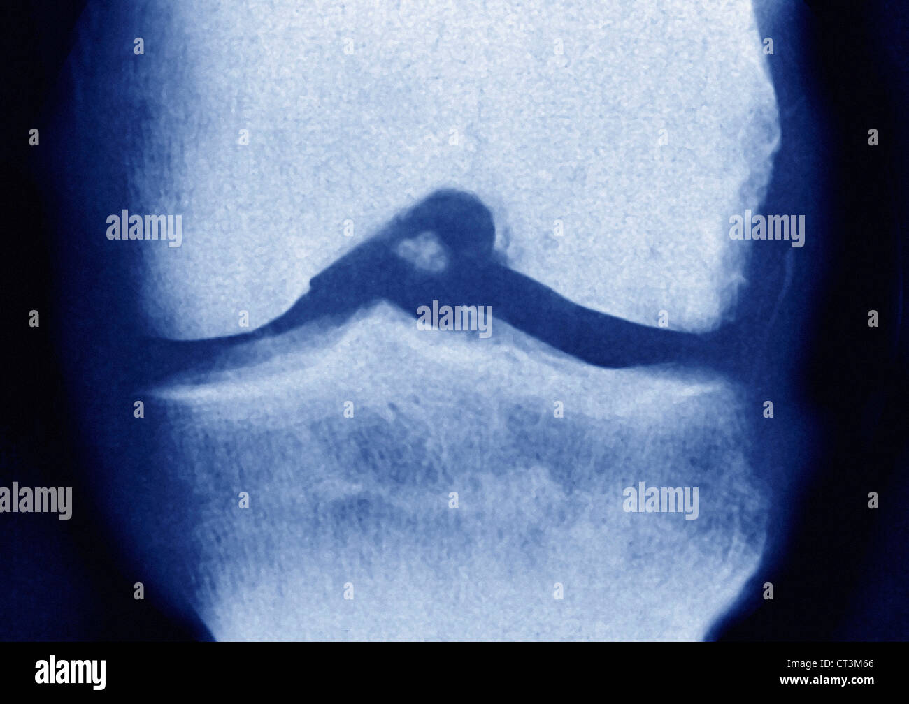 Osteochondritis dissecans hi-res stock photography and images - Alamy