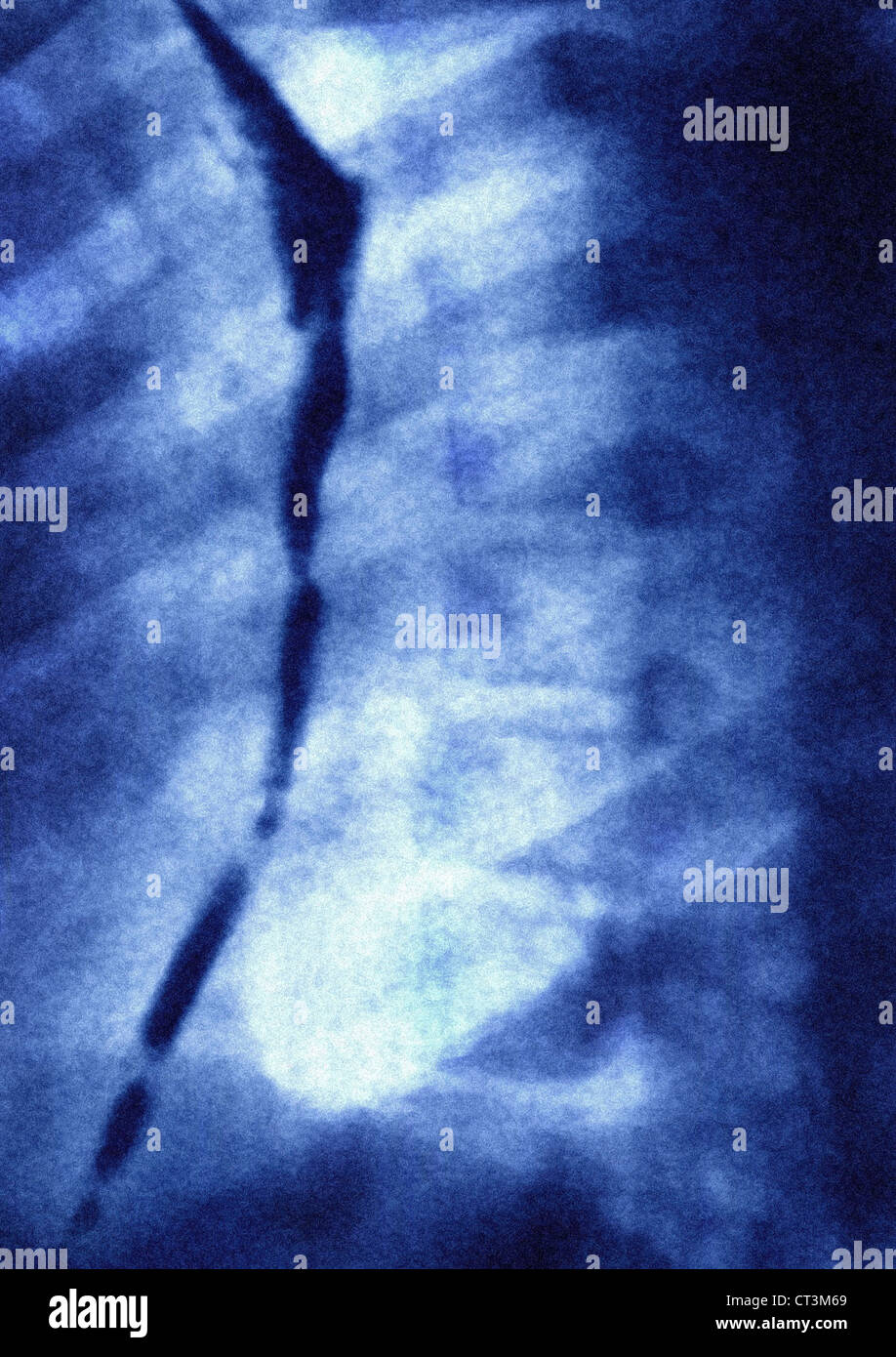 OESOPHAGUS BURN, X-RAY Stock Photo - Alamy
