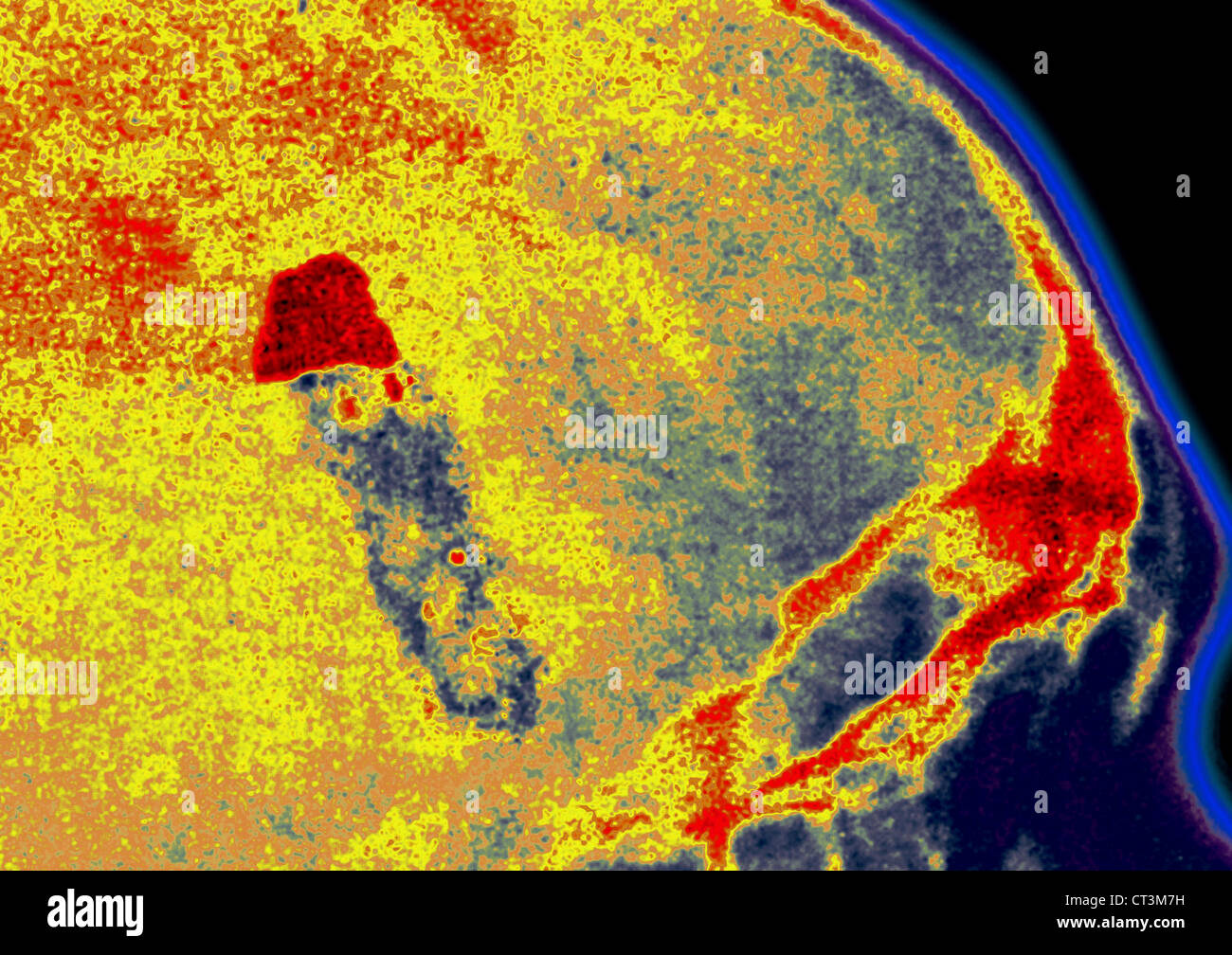 Foreign object body hi-res stock photography and images - Alamy