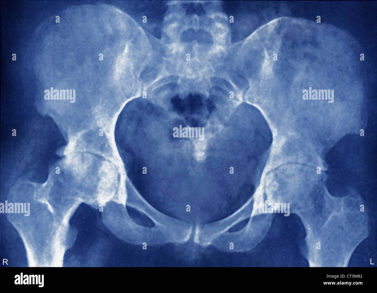 HIP OSTEOARTHRITIS, X-RAY Stock Photo - Alamy