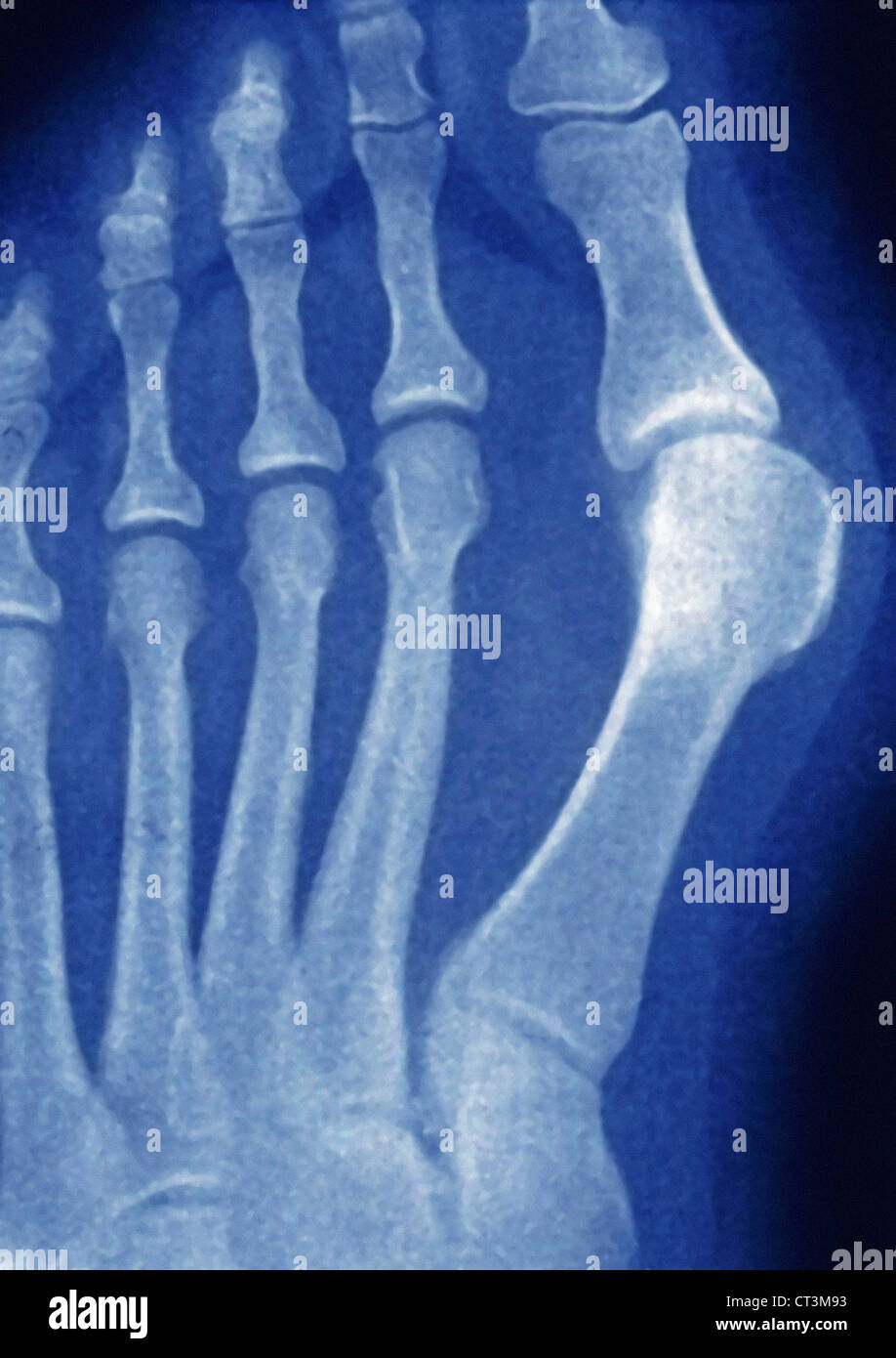 Hallux Valgus X Ray Bunions FootEducation