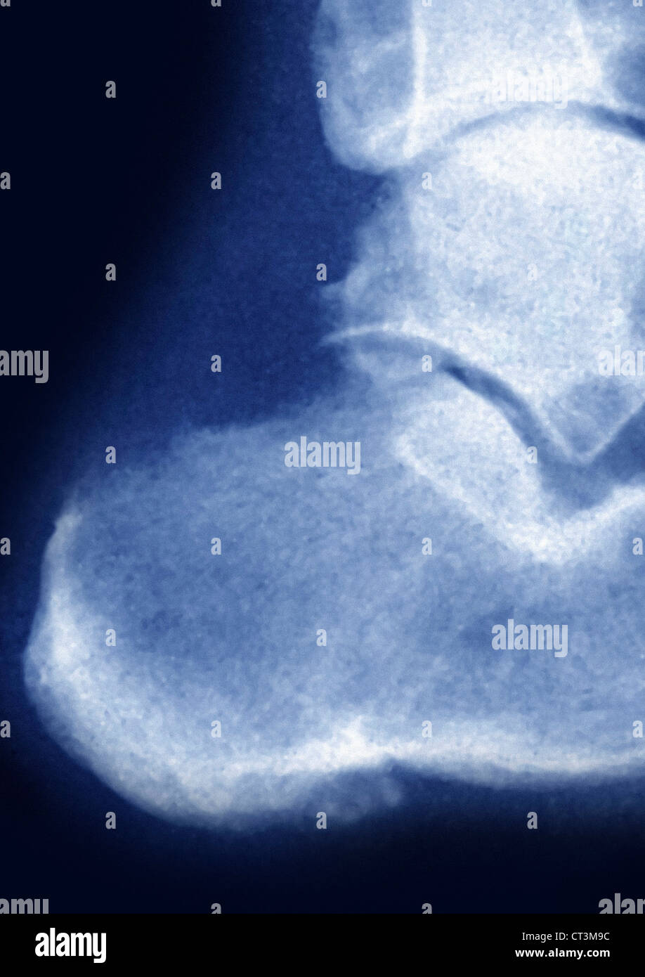 Osteochondroma hi-res stock photography and images - Alamy