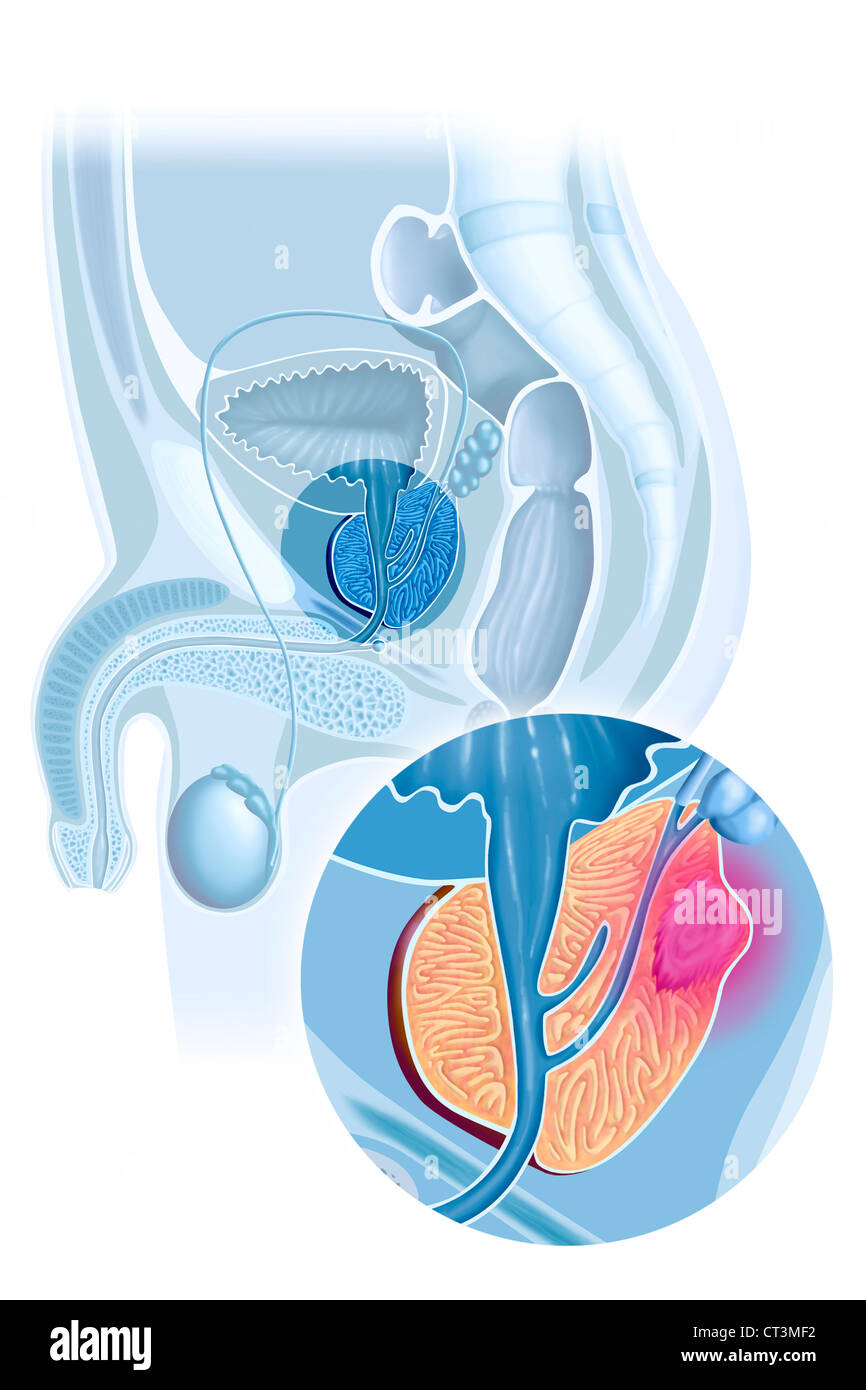 Medical cancer male Cut Out Stock Images & Pictures - Alamy