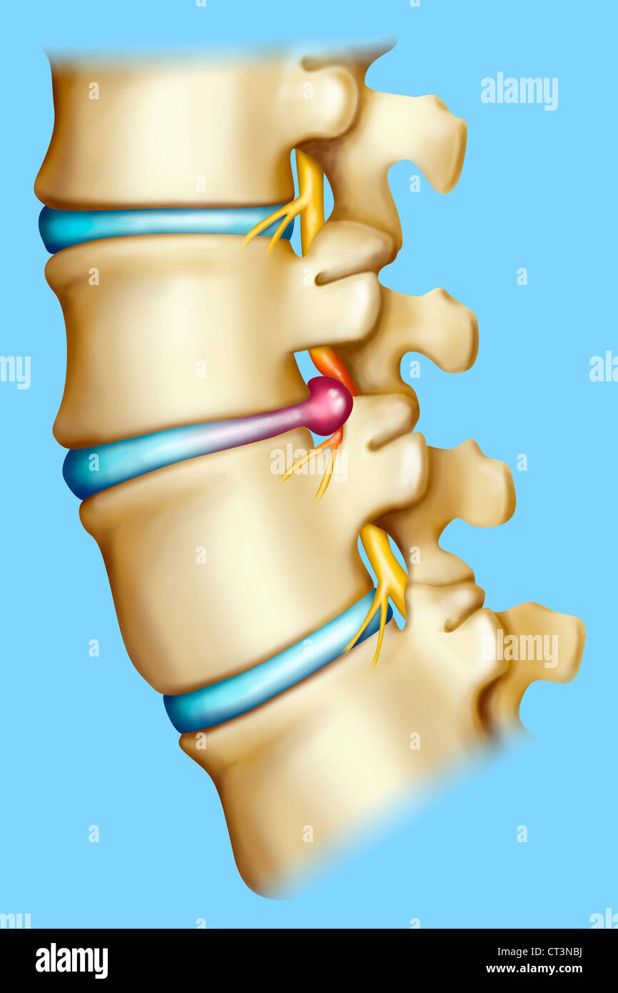 HERNIATED DISK, ILLUSTRATION Stock Photo - Alamy